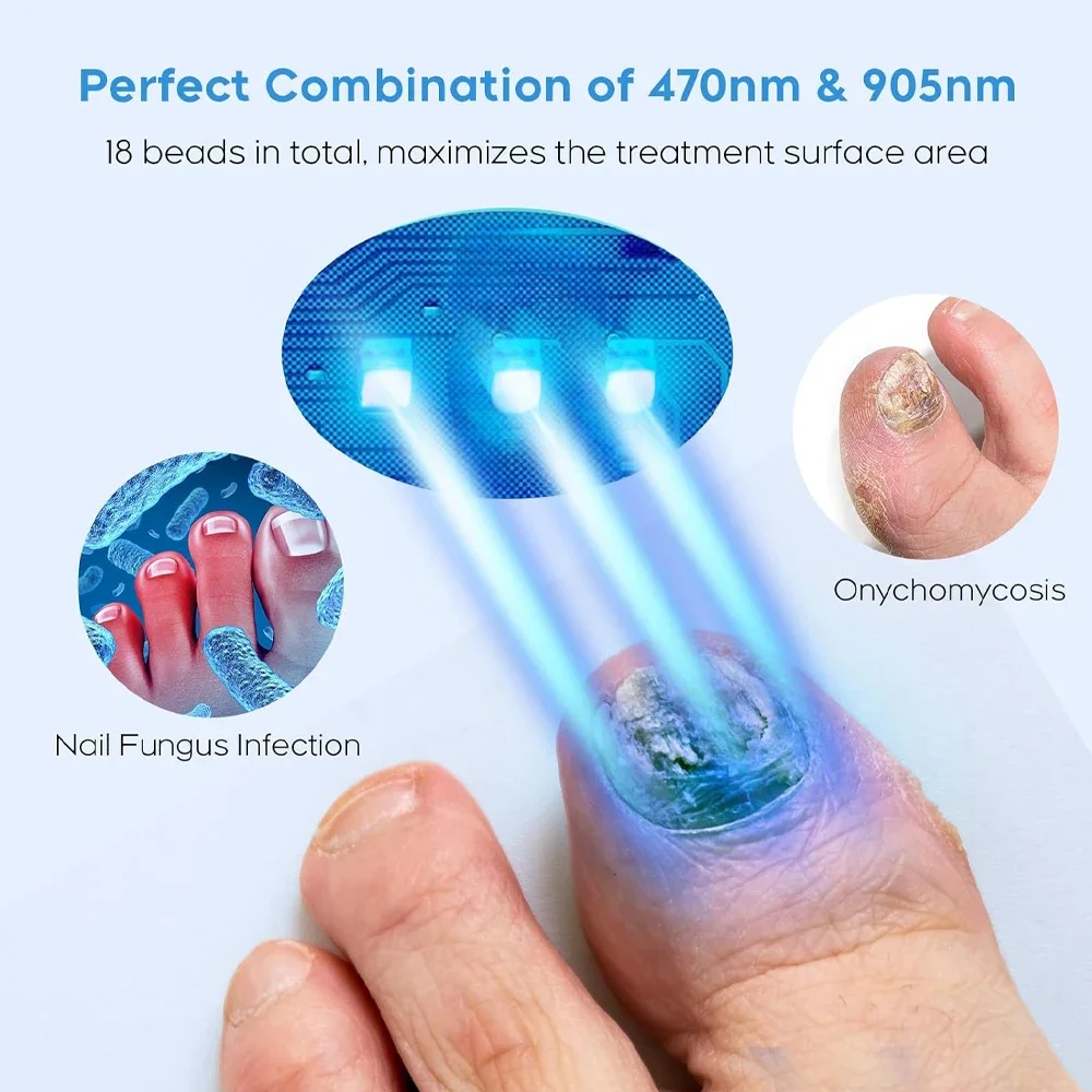 Fungal Nail Laser Device Repair Fast Nails Fungus Onychomycosis Anti ...